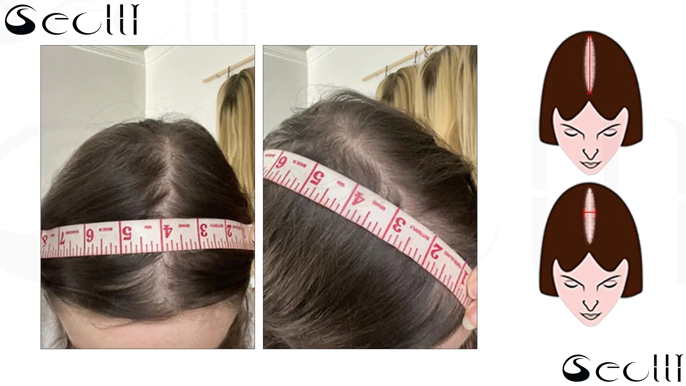 How to Measure Your Hair Loss Areas – SEULLY
